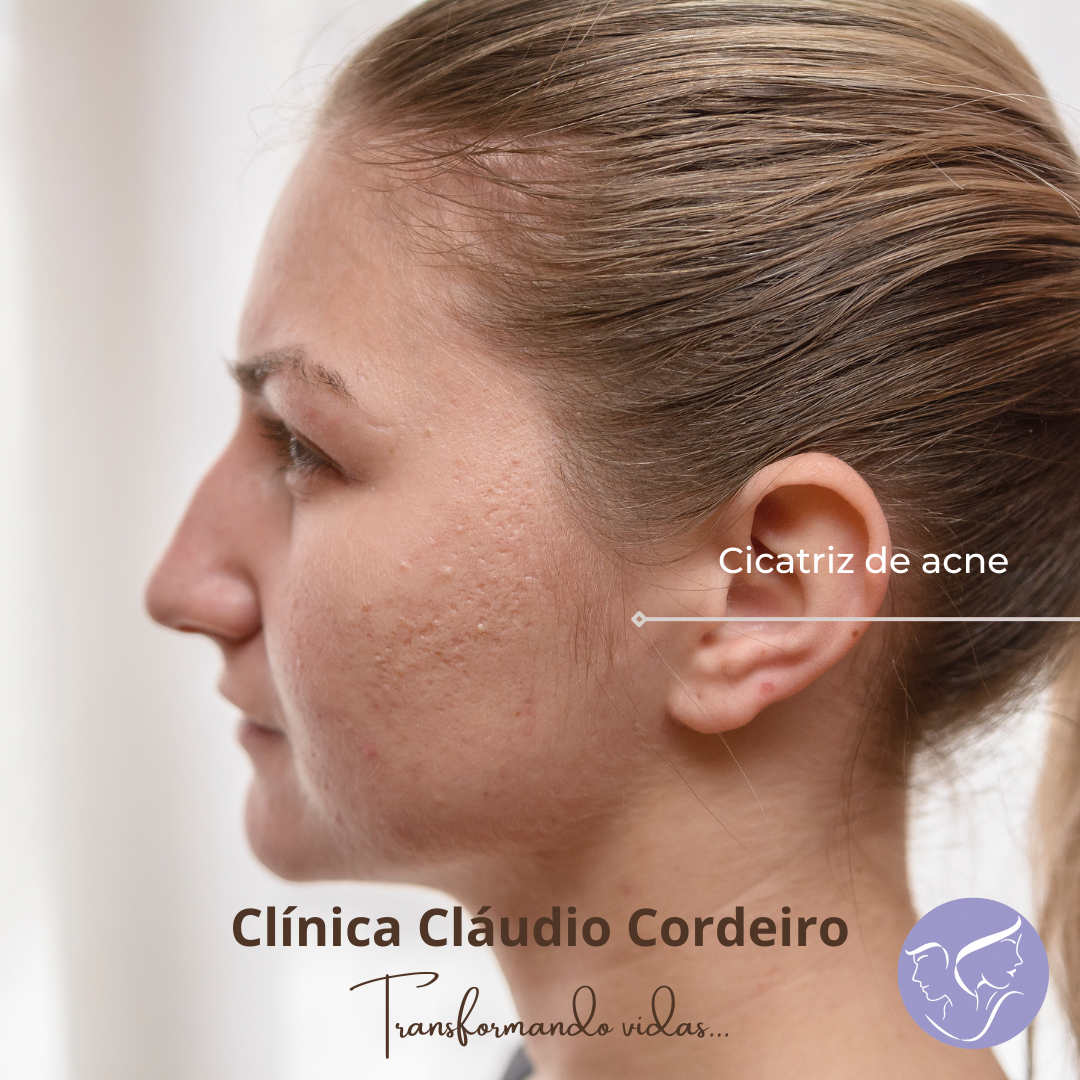 Cicatriz de acne tratada com segurança. Saiba mais!